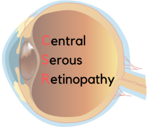 Clarity Amidst Clouds: Understanding Central Serous Retinopathy (CSR ...