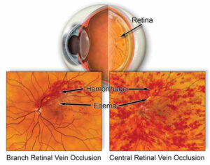 Understanding CRVO and BRVO: Causes, Symptoms, and Treatment Options ...